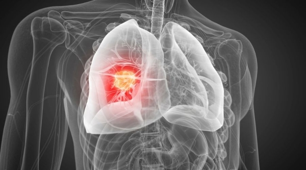 How Does Air Pollution Cause Lung Cancer? – Smart Air